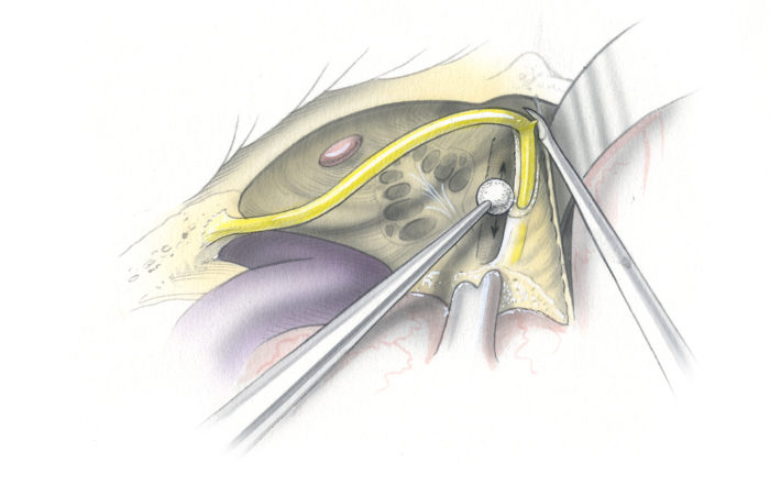 Transcochlear approach – Skull Base Surgery Atlas