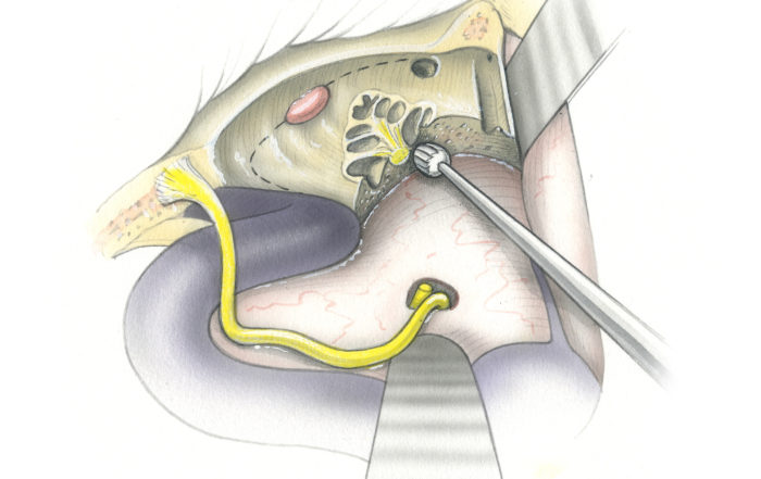 Transcochlear approach – Skull Base Surgery Atlas