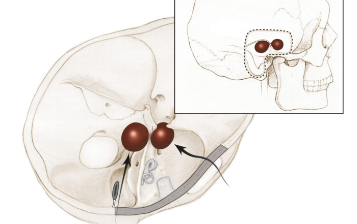 Combined Middle and Posterior Fossa Approach – Skull Base Surgery Atlas