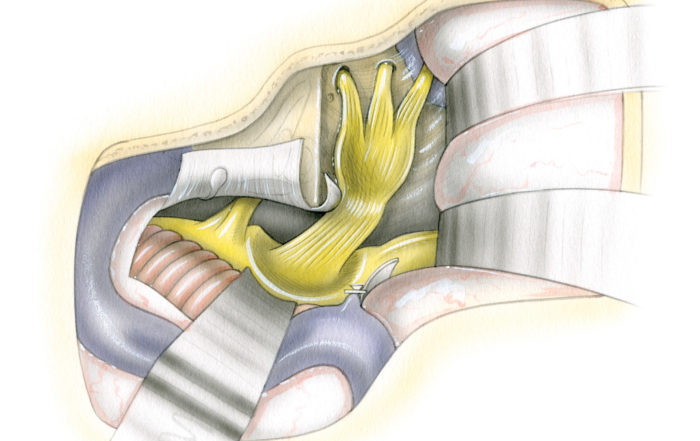 Combined Middle and Posterior Fossa Approach – Skull Base Surgery Atlas