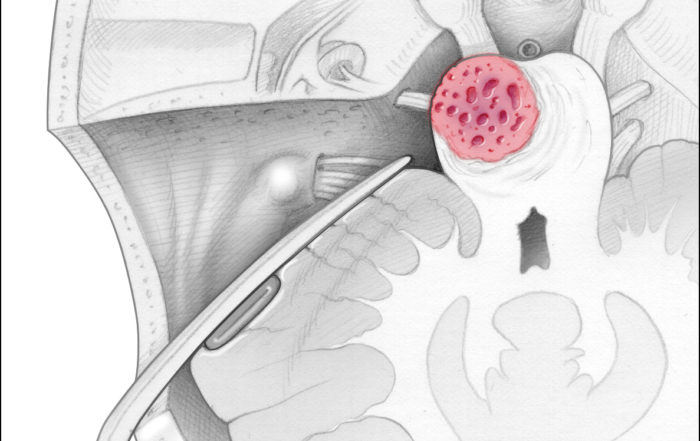 Vascular Considerations in Lateral Skull Base Surgery – Skull Base ...