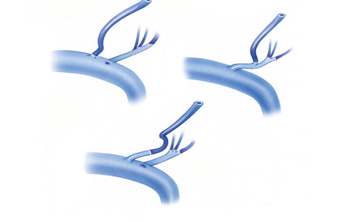 Vascular Considerations in Lateral Skull Base Surgery – Skull Base ...