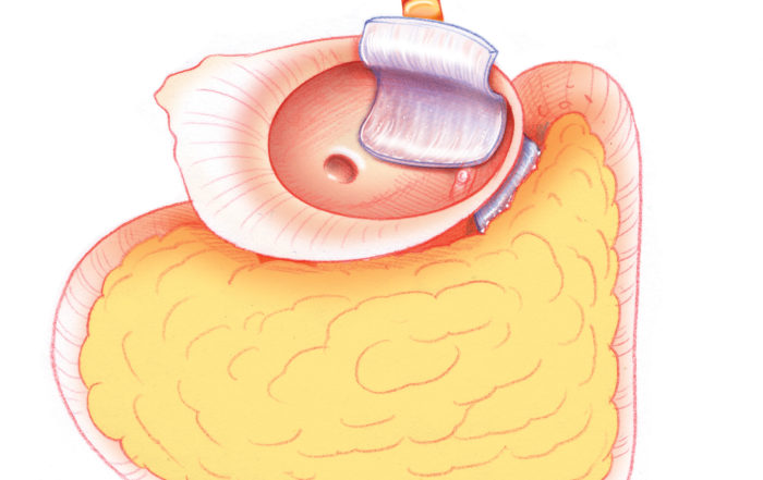 Cerebrospinal Fluid Leak – Skull Base Surgery Atlas