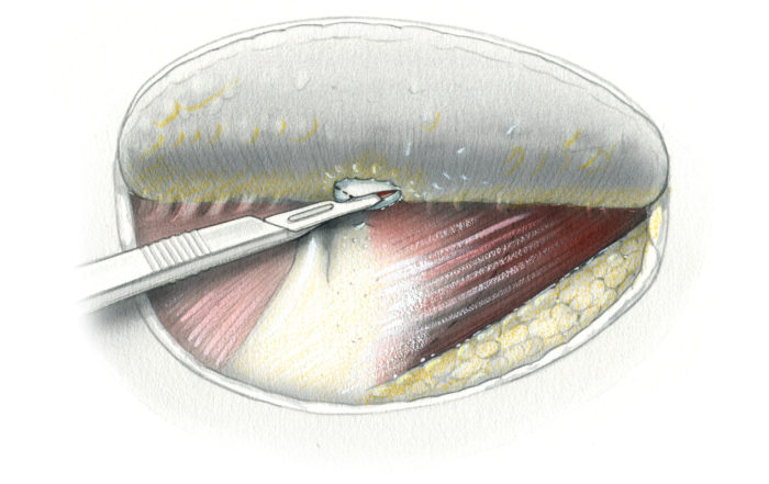 Ear Canal Closure in Skull Base Surgery – Skull Base Surgery Atlas