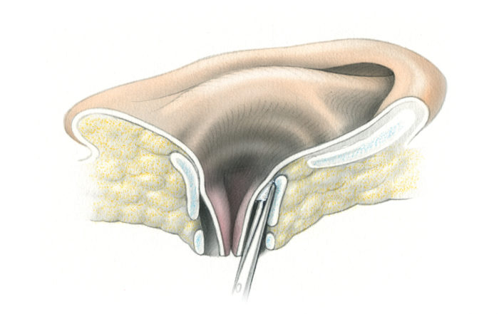 Ear Canal Closure in Skull Base Surgery – Skull Base Surgery Atlas