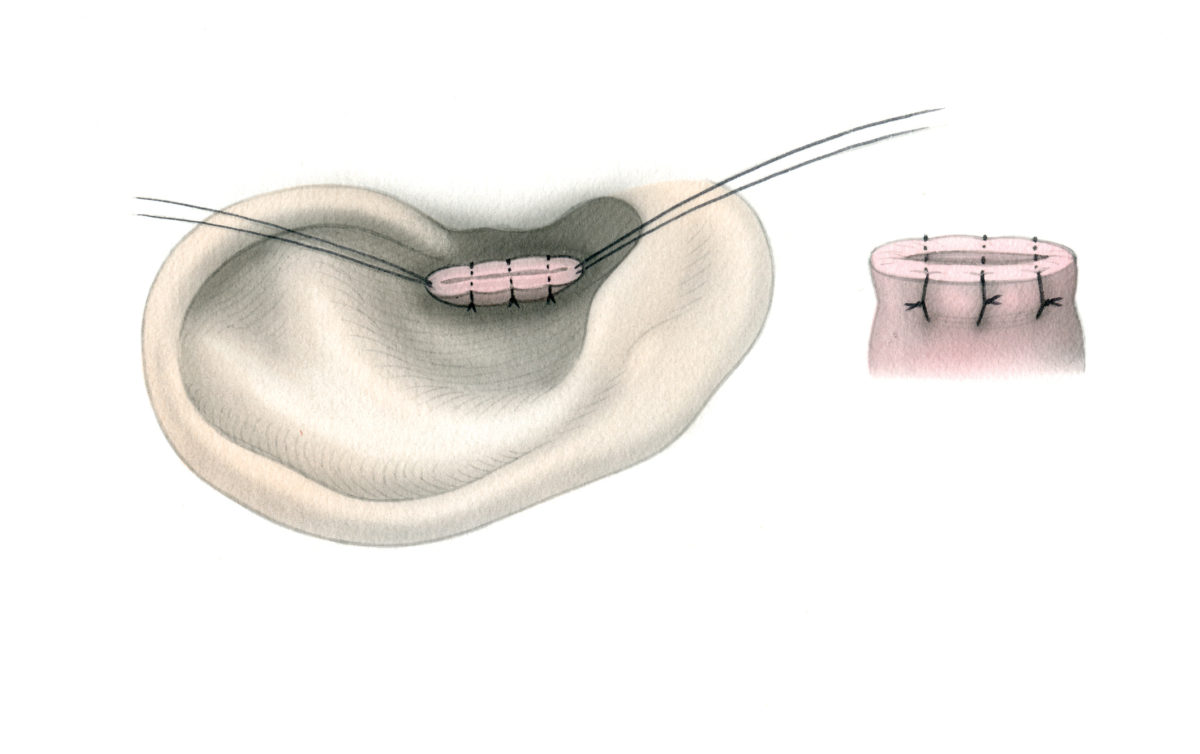 Ear Canal Closure in Skull Base Surgery – Skull Base Surgery Atlas