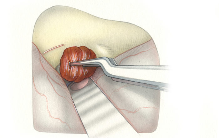 Middle Fossa Approach to the Internal Auditory Canal – Skull Base ...