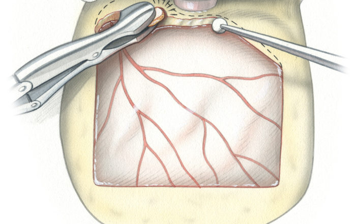 Middle Fossa Approach to the Internal Auditory Canal – Skull Base ...