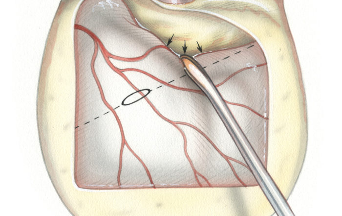 Middle Fossa Approach to the Internal Auditory Canal – Skull Base ...