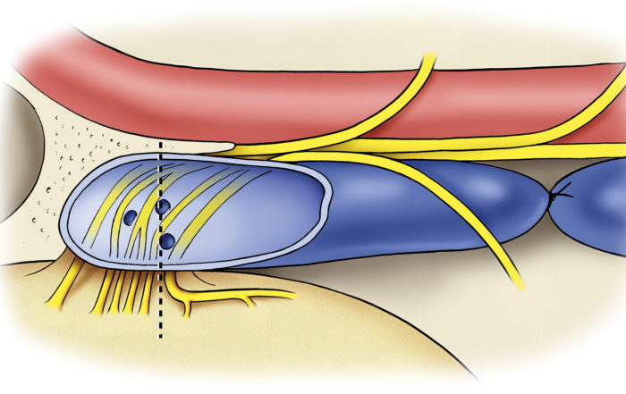 Jugular Foramen Approaches – Skull Base Surgery Atlas